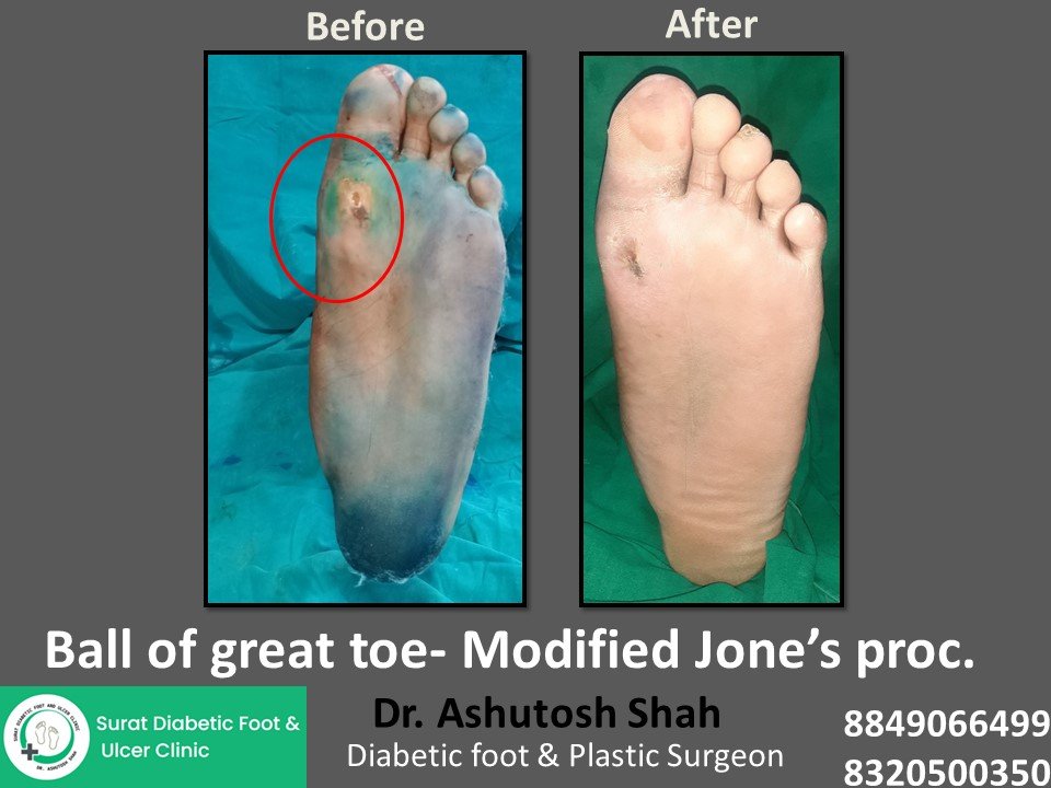Photos - Surat Diabetic Foot Care