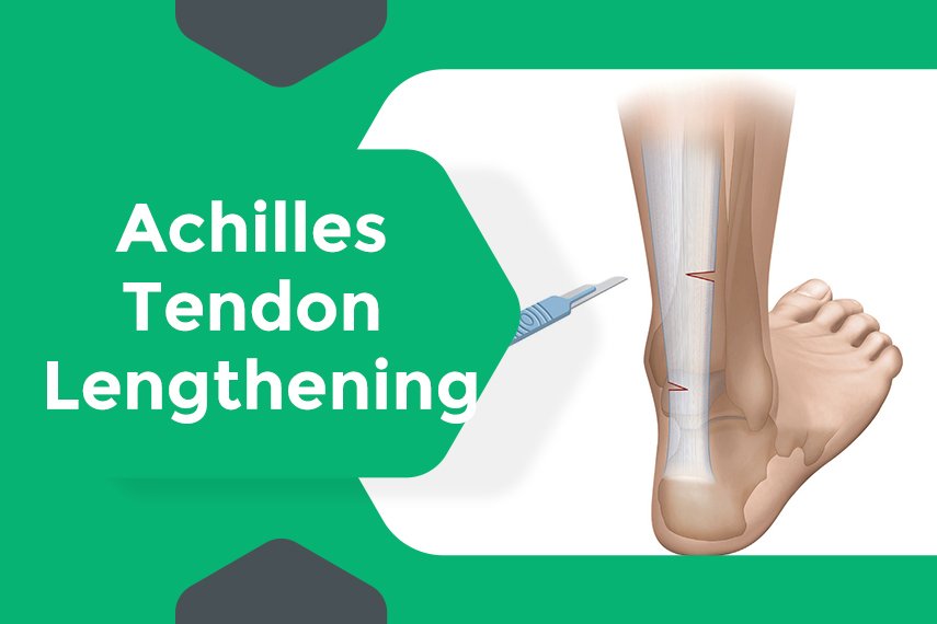 Tendon Release Surgery On Foot Best Sale Emergencydentistry