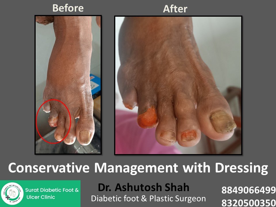 Photos - Surat Diabetic Foot Care