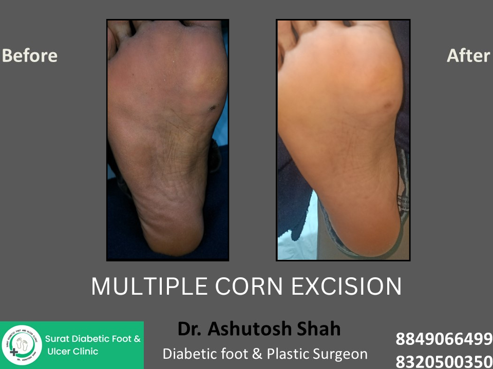 Photos - Surat Diabetic Foot Care