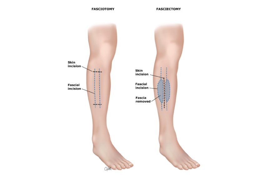 Cut Open Foot Surgery