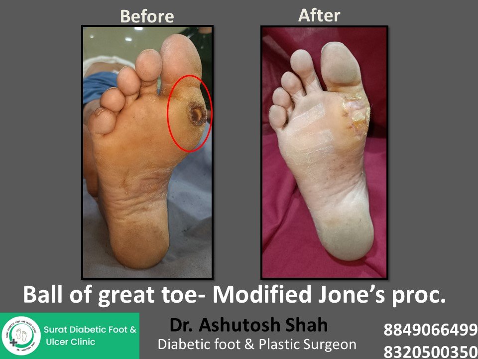 Photos - Surat Diabetic Foot Care
