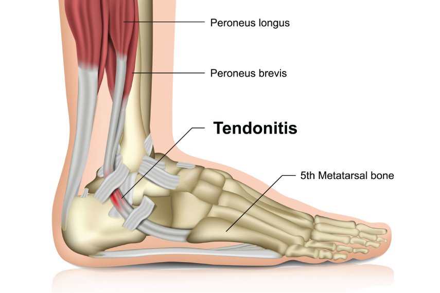 Tendonitis