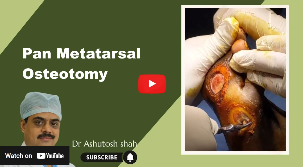 Metatarsal Osteotomies | Metatarsal Bone Treatment in Surat
